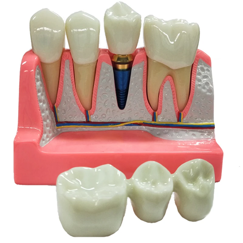 Dental Implant Analysis Model Teaching Study Demo Removable Crown Brid ...